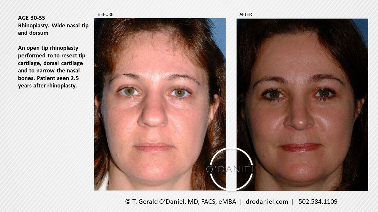 Rhinoplasty Case Study | Wide Nasal Tip & Dorsum | Age - 30-35 ...